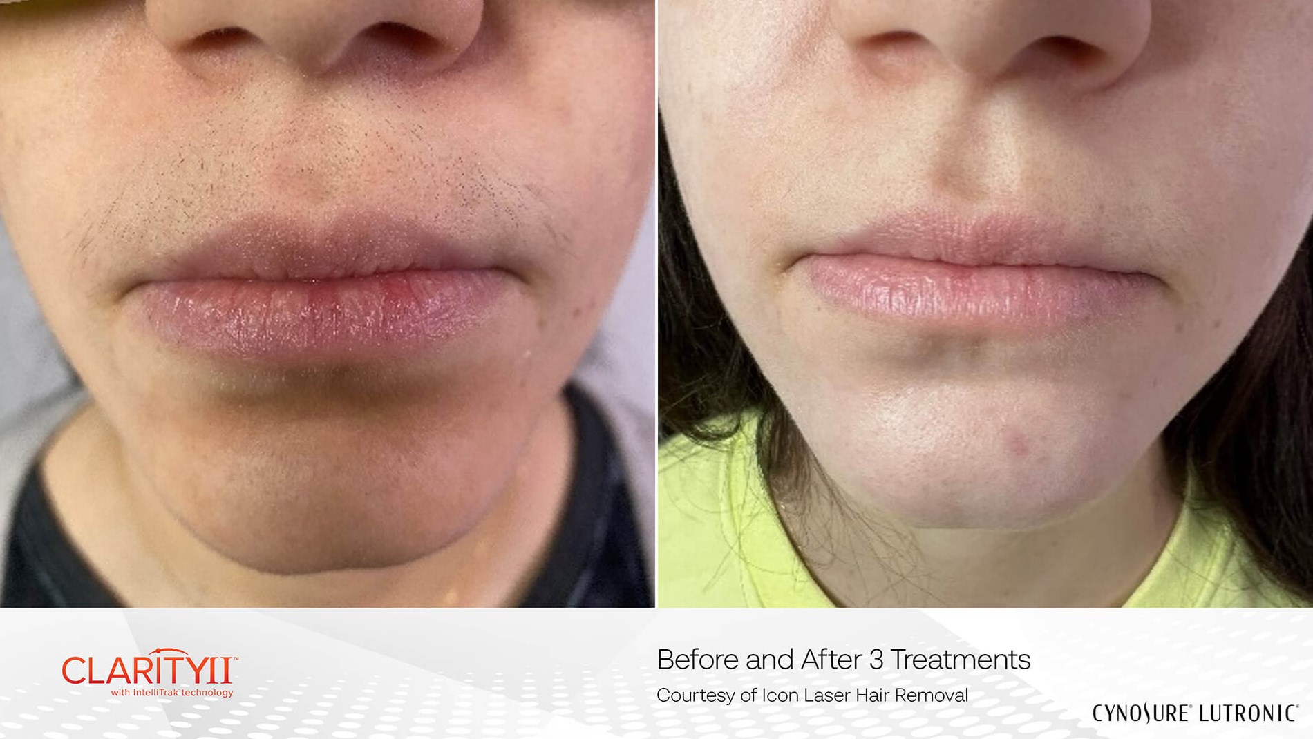 Discover the Benefits and Science Behind Clarity II Laser Hair Removal ...